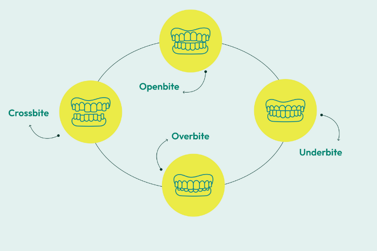malocclusion types